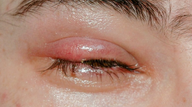 Infections of the Eye : Causes, Symptoms, Treatment and More